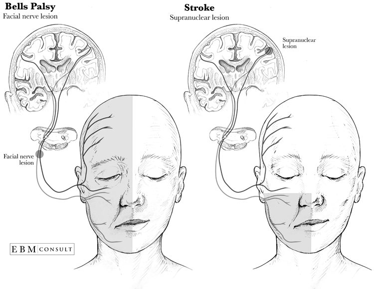Anatomy Stroke Vs Bells Palsy